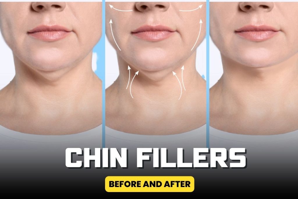 Capturing The Narrative Of Chin Filler Before And After